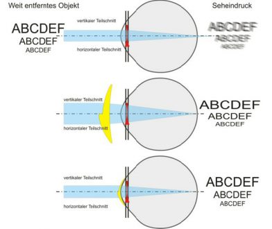 Astigmatismus – die-contact-linse